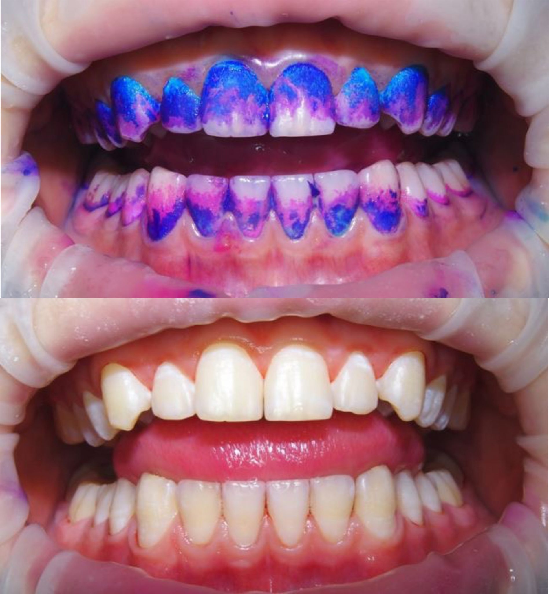 AIRFLOW GBT Hygiene Edmonton AB, Kucey Dental Group